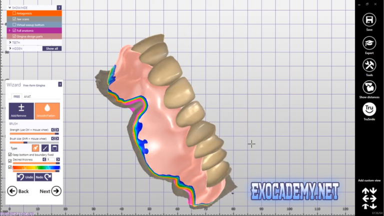Waxup and Bite Splint – FREE – XOcademy
