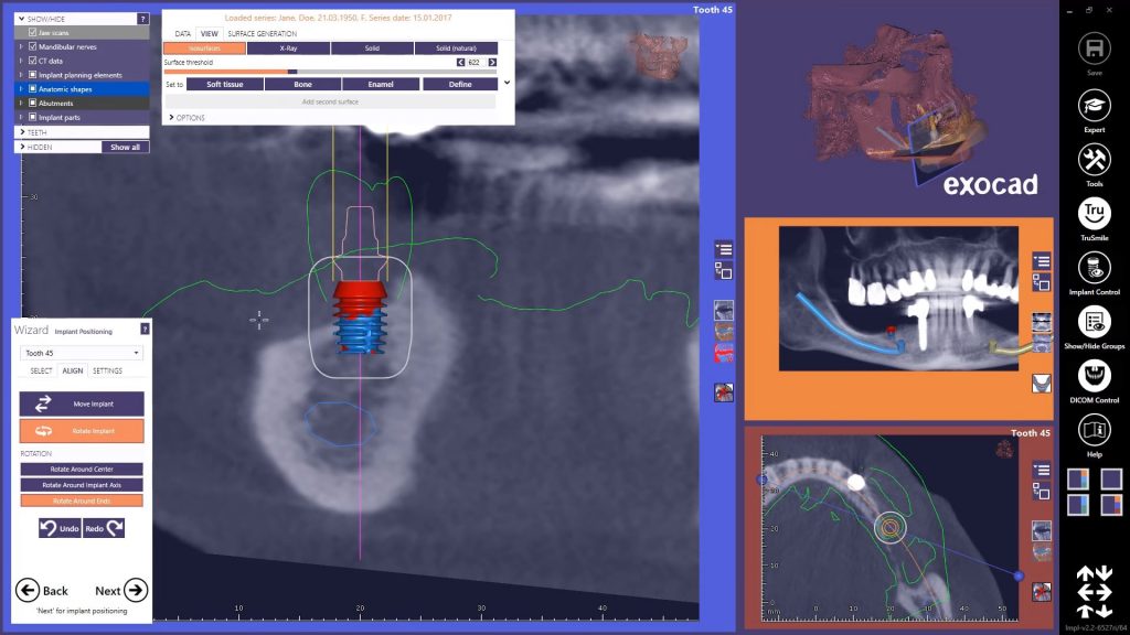 exoplan with Surgical Guide Designer module bundle – XOcademy
